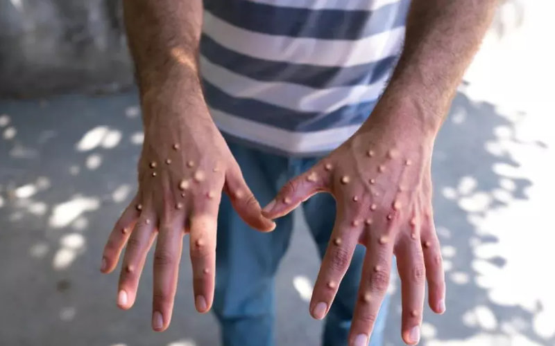 La variole du singe : c'est quoi au juste ? ⋆ News RIM